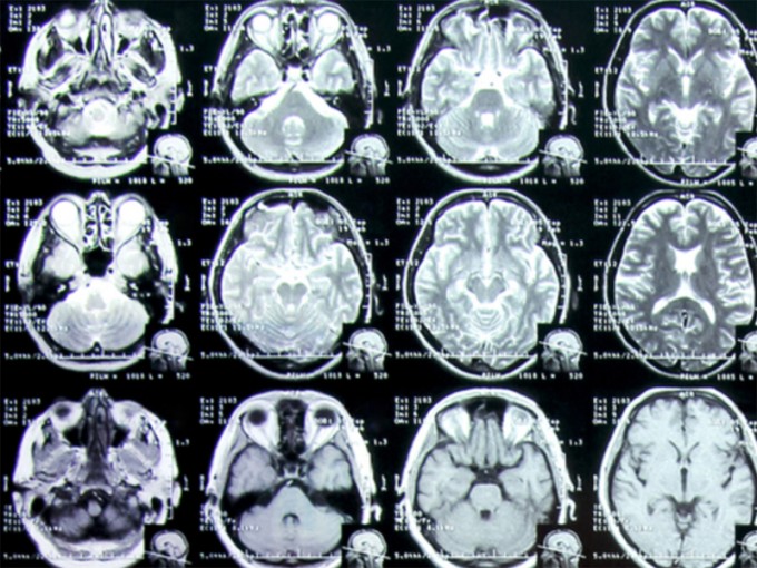 Imaging study confirms differences in ADHD brains • The Medical Republic