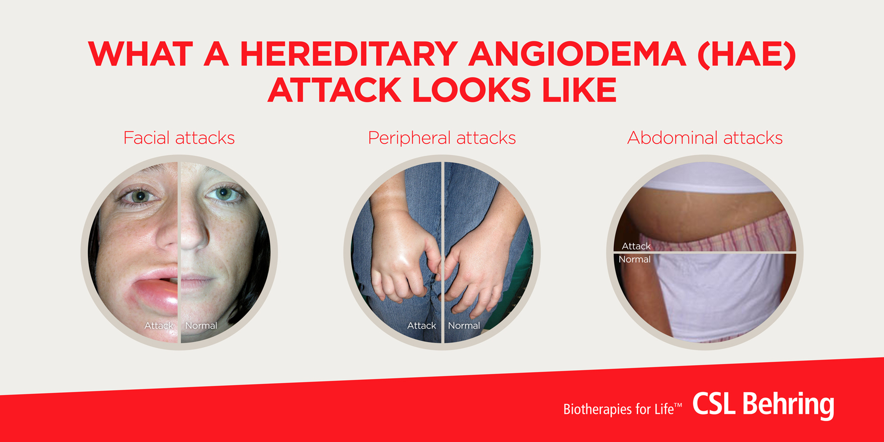 Hereditary Angioedema _ Hereditäres Angioödem Altmeyer – WDXO