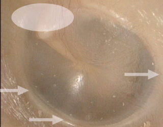 Tympanic membrane perforations: the safe versus the unsafe • The ...