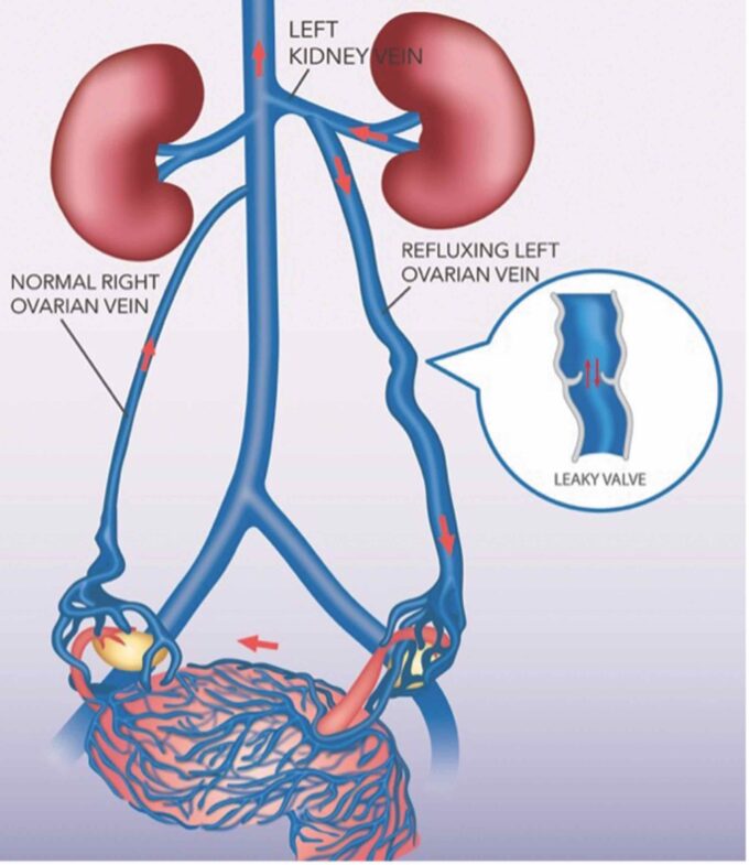 Treatment Of Varicose Veins Spider Veins Pelvic Conge