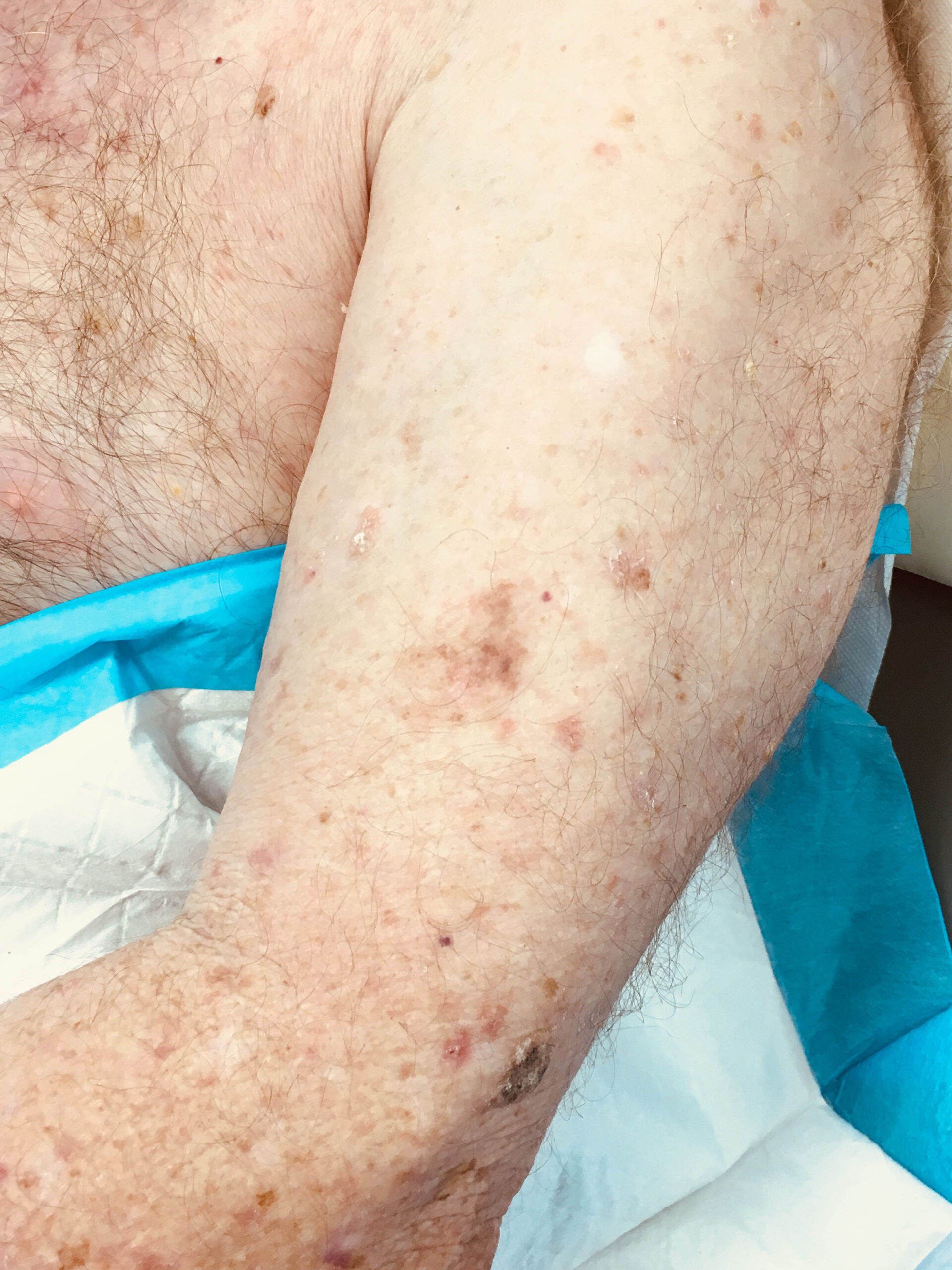 Subtle melanomas: what to know - Medical Republic