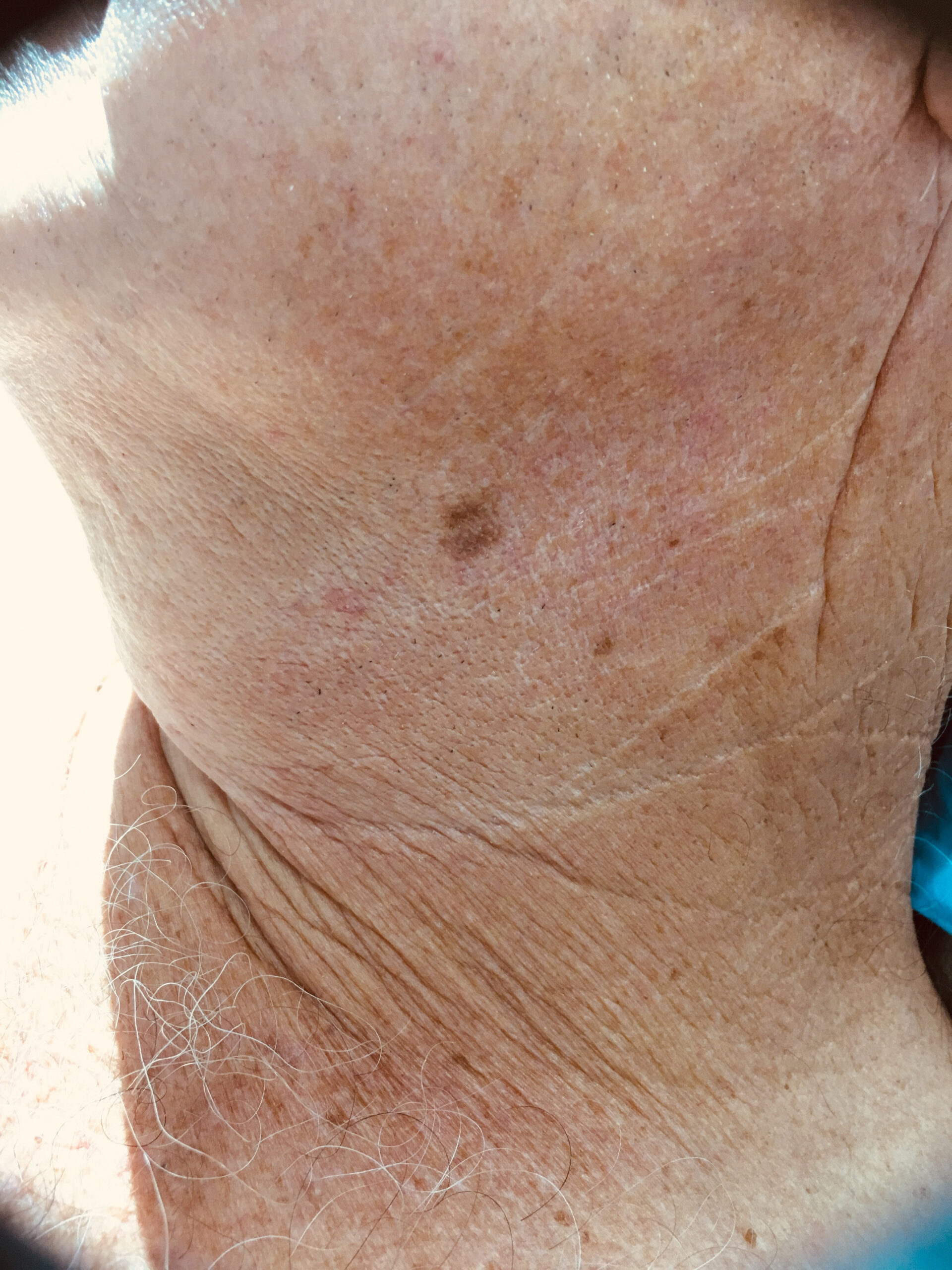 Subtle melanomas: what to know - Oncology Republic