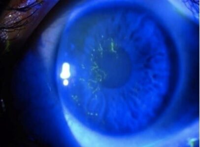 Spotting and treating herpes zoster ophthalmicus • The Medical Republic